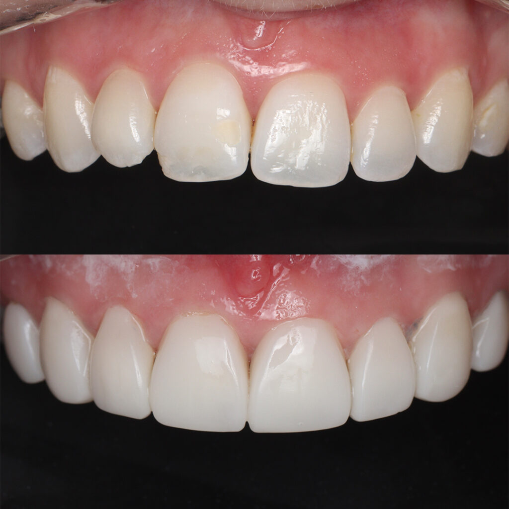 Composite Bonding Kilburn | Queens Park Cosmetic Dentistry